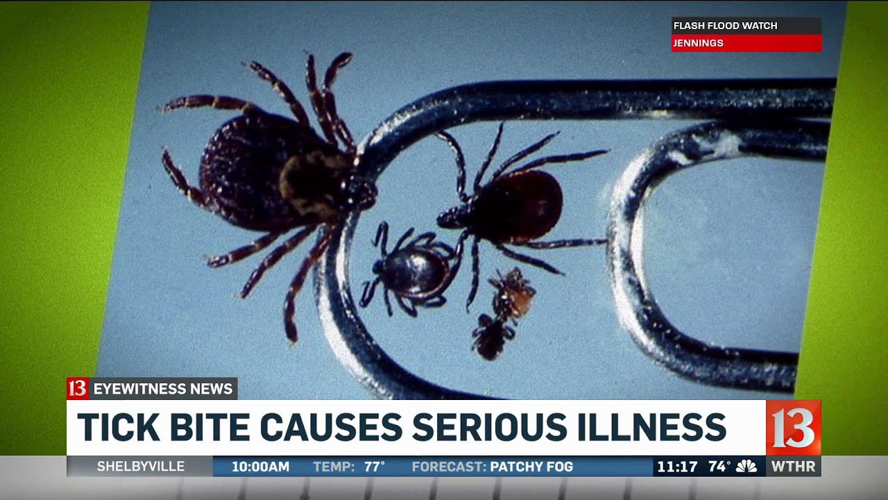 Tick bites can cause serious illness