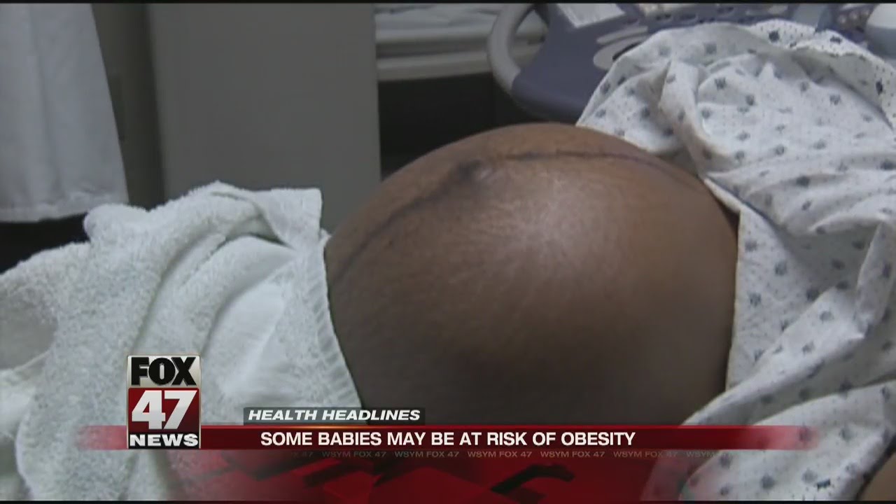 C-section may increase risk of childhood obesity