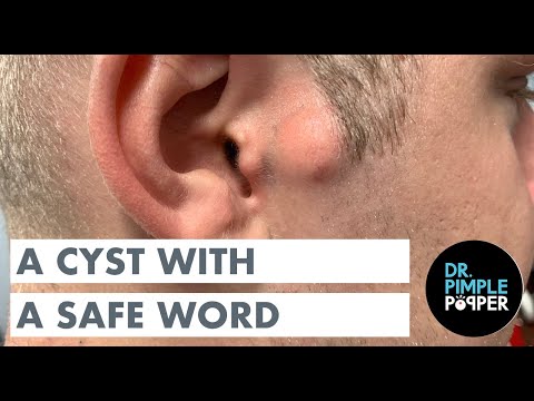 Dr. Pimple Popper Pops Exploding Ear Cyst In New Instagram Video