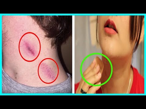 Get Rid Of Hickey - Tips On How To Get Rid Of Hickeys