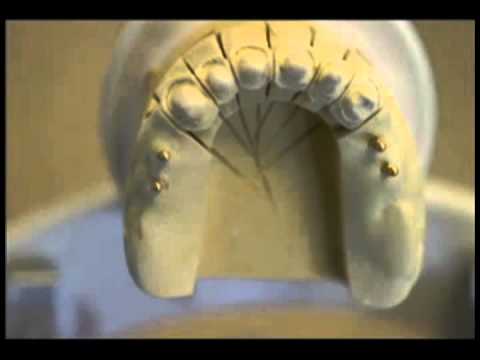 IMTEC Mini Dental Implants and Full Bridges
