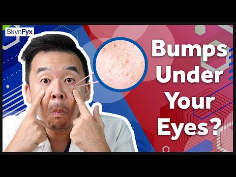 Milia, Syringoma, Skin Tag & F*** Spots Explained