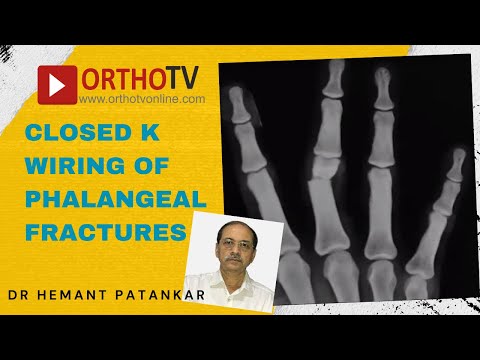 Closed K Wiring of Phalangeal Fractures - Dr Hemant Patankar