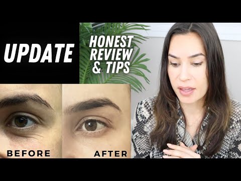 1+ Year PRF Update - BEST, NATURAL treatment for under eyes | PRF - Platelet Rich Fibrin