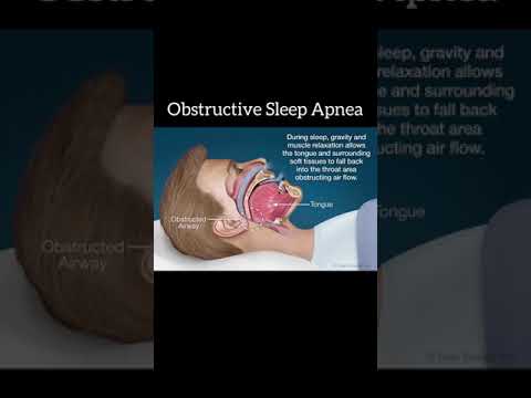 Obstructive vs Central Sleep Apnea