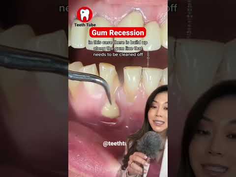 Gum recession due to build up. #gumrecession #plaque #tartar #calculus #dentist #dentistry