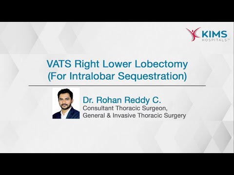 Advancing Lung Surgery: Benefits of VATS (Video-assisted Thoracic Surgery) for Lung Resection