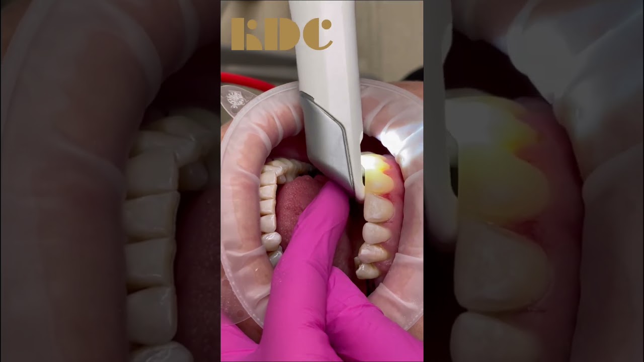 No more impressions! Check out our digital scanner 😎