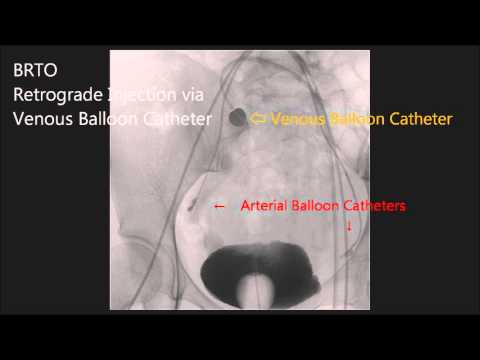 Balloon-occluded Retrograde Transvenous Obliteration for Uterine Arteriovenous Malformation