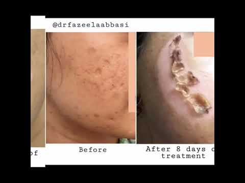 Ablative Erbium Yag Laser.