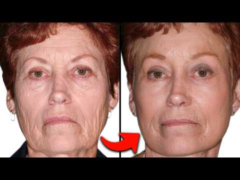 Is CO2 Fractional Laser Resurfacing WORTH IT? Plastic Surgeon Answers