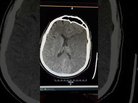 Left MCA territory CVA/ ischemic stroke ct scan,cytotoxic edema( both white/gray matter hypodensity)