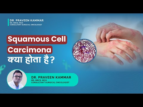 What is Squamous Cell Carcimona? | Squamous Cell Carcimona क्या होता है | Dr. Praveen kammar, Mumbai