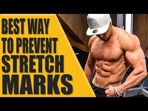 Best way to prevent stretch marks?