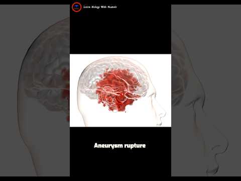 What is An Aneurysm ? brain Aneurysm 🧠! #shorts