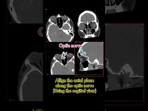 Neuro-ocular plane for CT orbits #CT #catscan #radiology #medicine #medicalstudent #anatomy