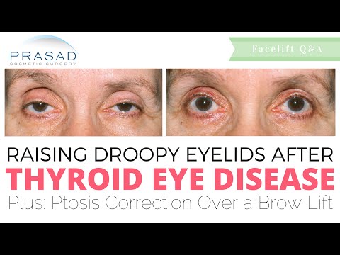 How Eyelid Ptosis (Drooping Eyelid) Can Happen After Thyroid Eye Disease/ Orbital Decompression