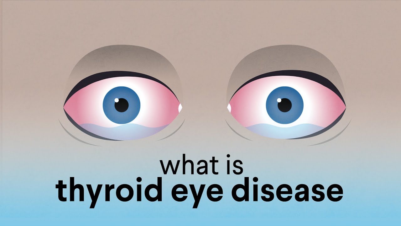 What is Thyroid Eye Disease (TED)?