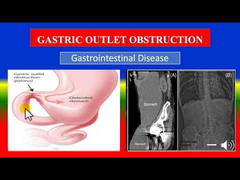 GASTRIC OUTLET OBSTRUCTION (GOO) - Definition, types, causes, patho, symptoms , diagnoses ,medicine