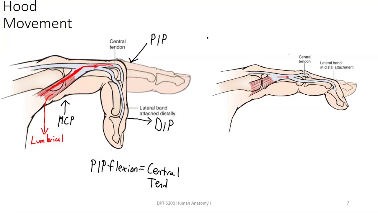 extensor hood and finger deformities