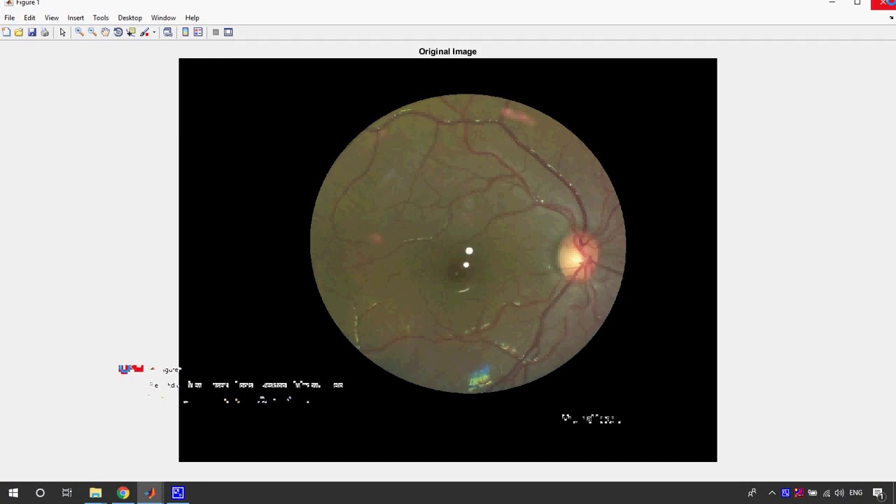 Detection of Diabetic Retinopathy in Matlab - OKOK PROJECTS- Final Year ...