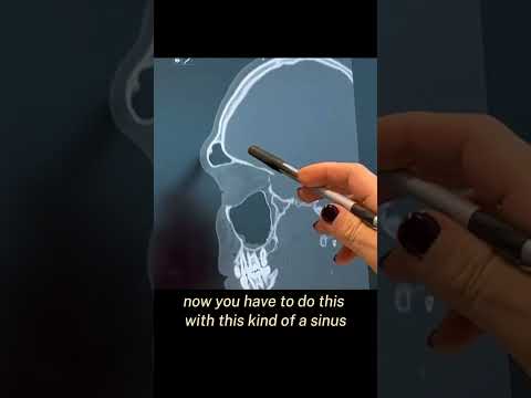 Brow Bossing Reduction Type III | FFS with Dr. Rodman in Houston, TX!