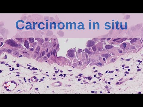 What is Carcinoma in situ? - Pathology mini tutorial