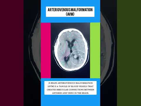 Arteriovenous malformation of brain #ctscan #CThead #brain #radiology #radiographer #shorts
