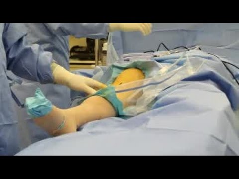 Step 8: Incision site marked