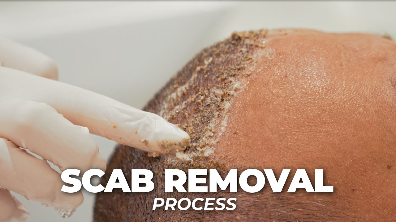 SCAB REMOVAL PROCESS EXPLAINED!