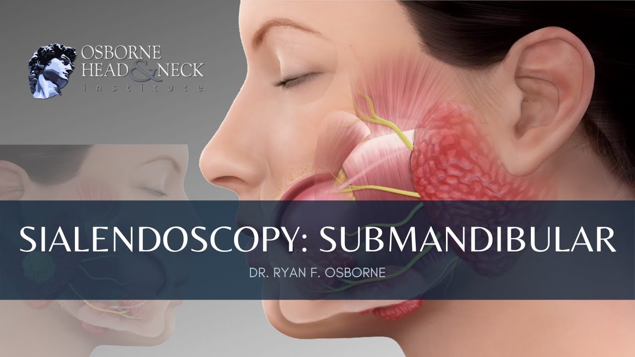 Sialendoscopy for Submandibular Gland Stones