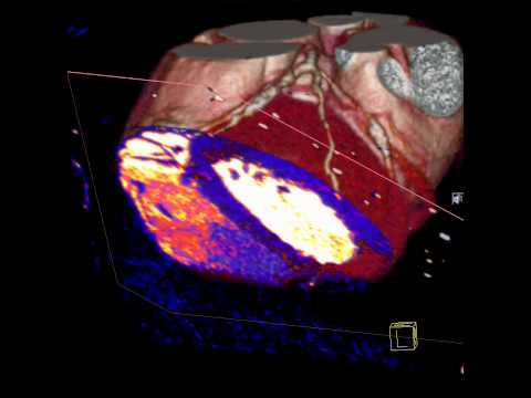 Dual-energy CT of the heart for diagnosing coronary artery stenosis and myocardial ischemia-initial