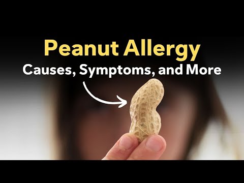 Peanut Allergy - Causes, Symptoms, Diagnosis Methods and More