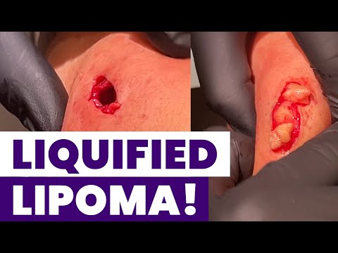 LIQUIFIED LIPOMA!