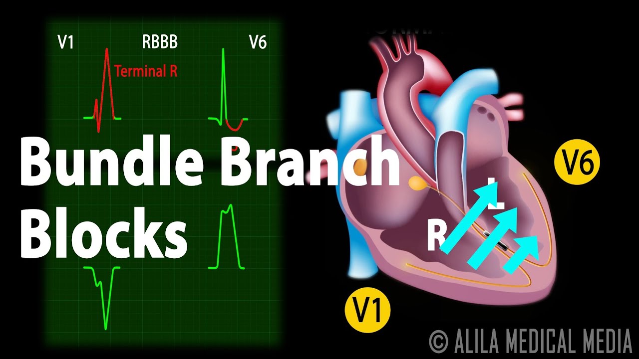 Bundle Branch Block, Animation.