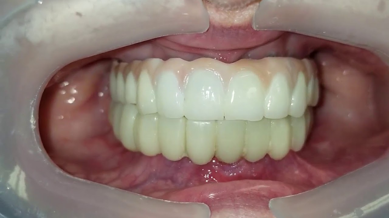 See full arch dental implant prosthetics.  FP1 and FP2  PMMA and Zirconium Dr. Josh Brower DDS.
