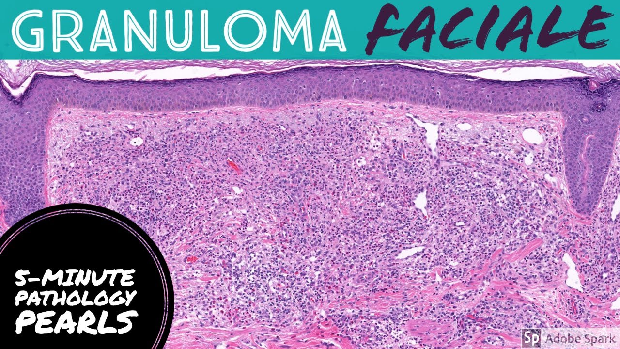 Granuloma Faciale: 5-Minute Pathology Pearls