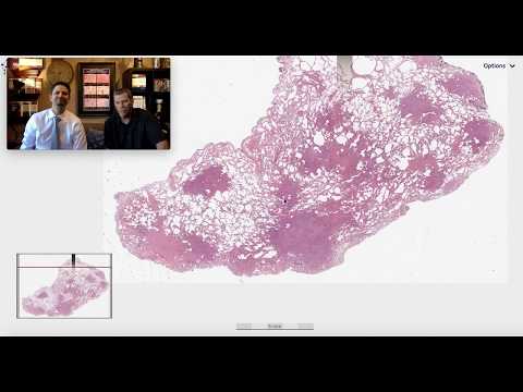 Pattern 5 - Nodular Pulmonary Langerhans Cell Histiocytosis