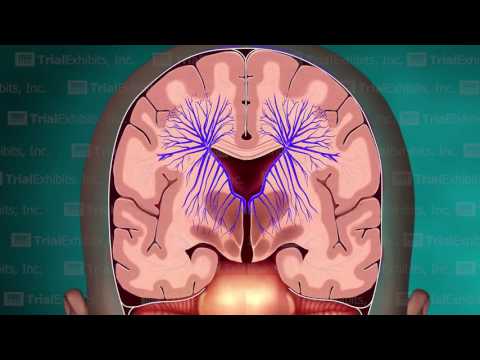 Deep Medullary Thrombosis