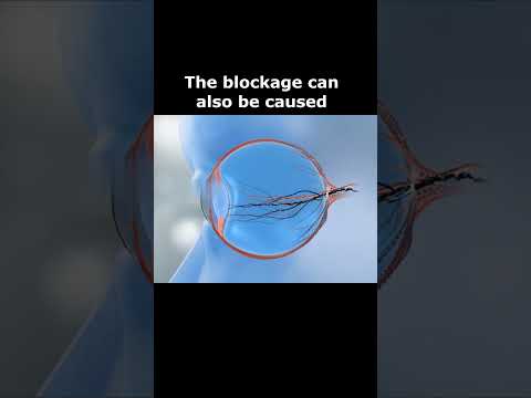 What causes a stroke in the eye