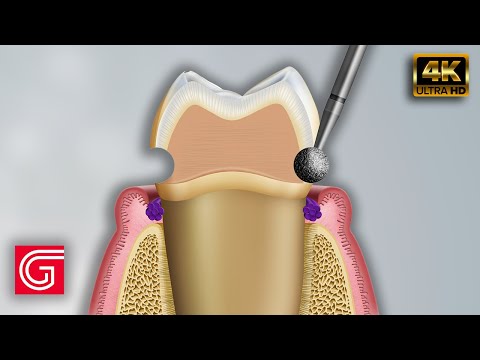 How to Prepare Teeth for Crown and Bridge by Michael DiTolla, DDS, FAGD