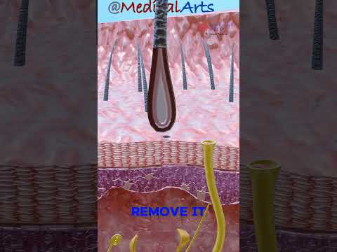 Blackhead video ⚫ Blackhead formation #dermatology