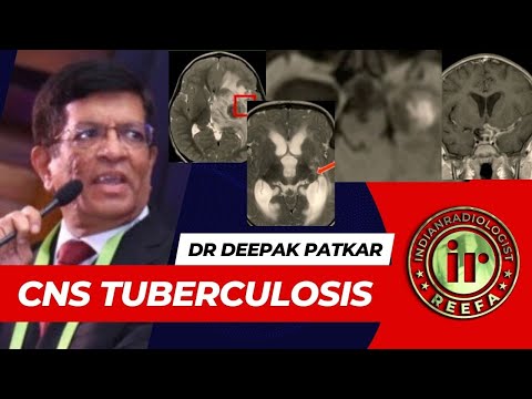 CNS TUBERCULOSIS | DR DEEPAK PATKAR || TB meningitis | Tuberculoma | Cysticercosis | T2Hypo
