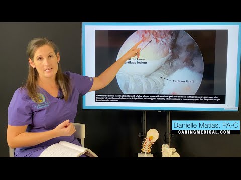Hip labral tear pain treatment with PRP Prolotherapy as a non-surgical or post-surgical option