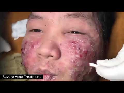 BEST BLACKHEAD AND WHITEHEAD REMOVAL! SEVERE ACNE TREATMENT - SATISFYING AND RELAXING VIDEO