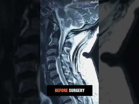 Before and After Spine Surgery #spinesurgery #surgery #backpain #spinesurgeon #backpaintreatment