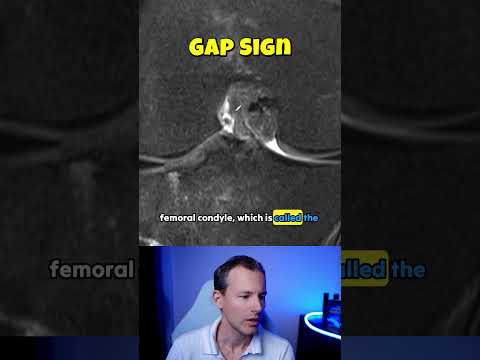 ACL Partial Tear with Gap Sign #radiology #kneeinjury #kneemri