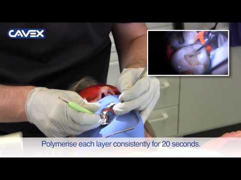 Quadrant Universal LC: universal hybrid composite