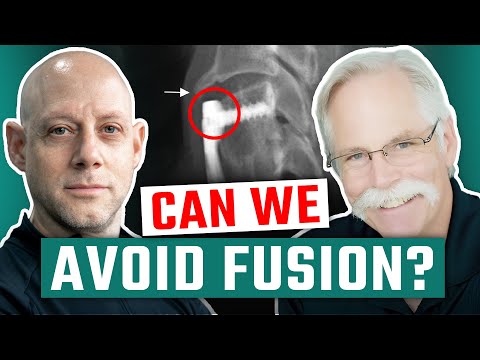 Can adjacent segment disease be avoided post spinal fusion? | The Spine X Change