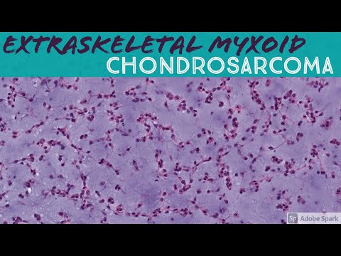 Extraskeletal Myxoid Chondrosarcoma: 5-Minute Pathology Pearls